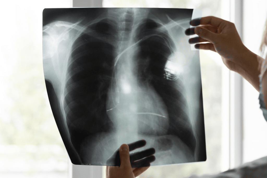 Heartburn: Gejala, Penyebab Dan Pengobatannya